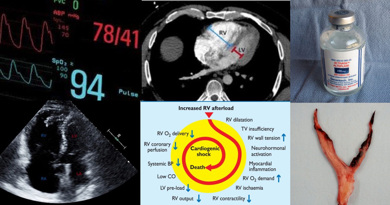 Acute Pulmonary Embolism Management Of Massive And Submassive
