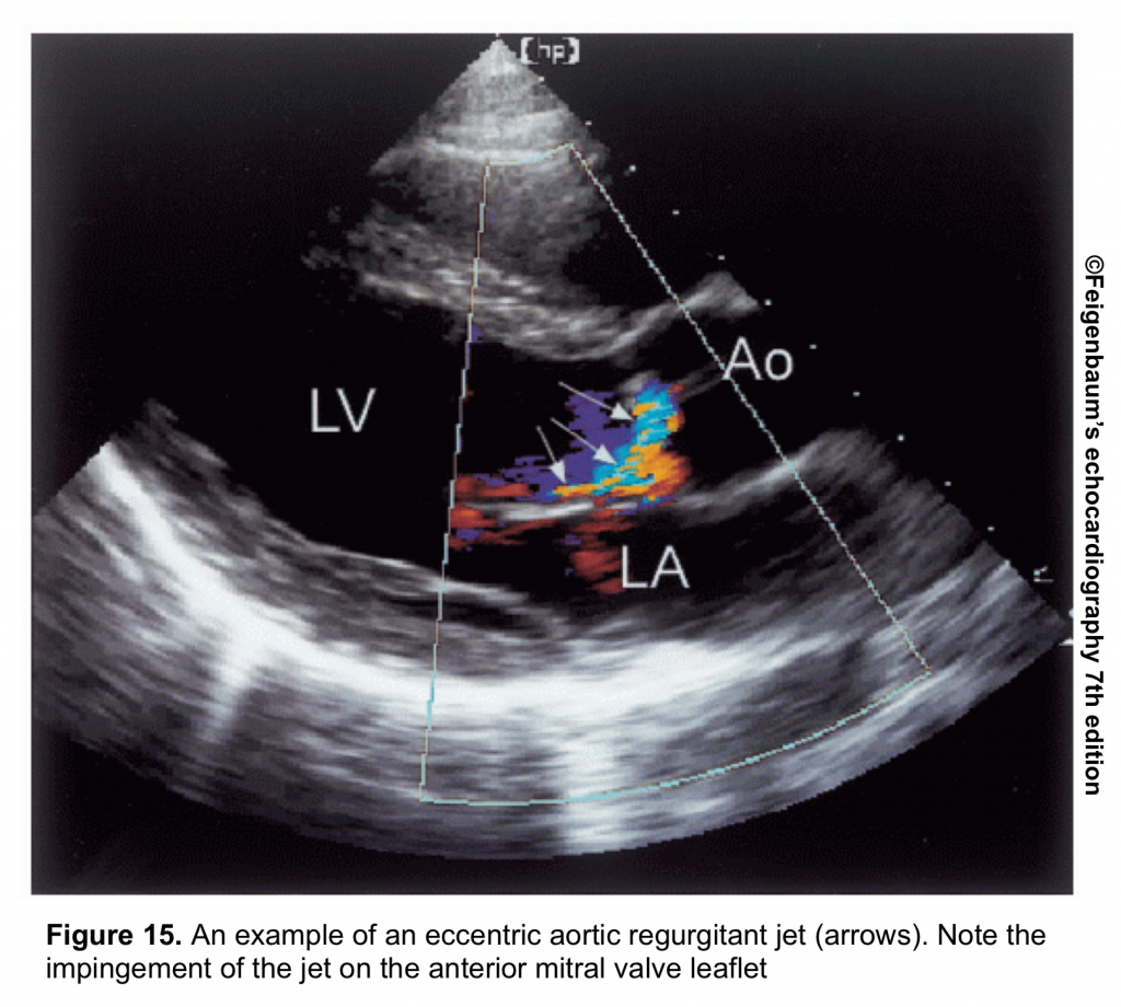 Valvular Emergencies Part 2: Diagnosis and Management of Severe Aortic ... Valvular Emergencies Part 2: Diagnosis and Management of Severe Aortic ...