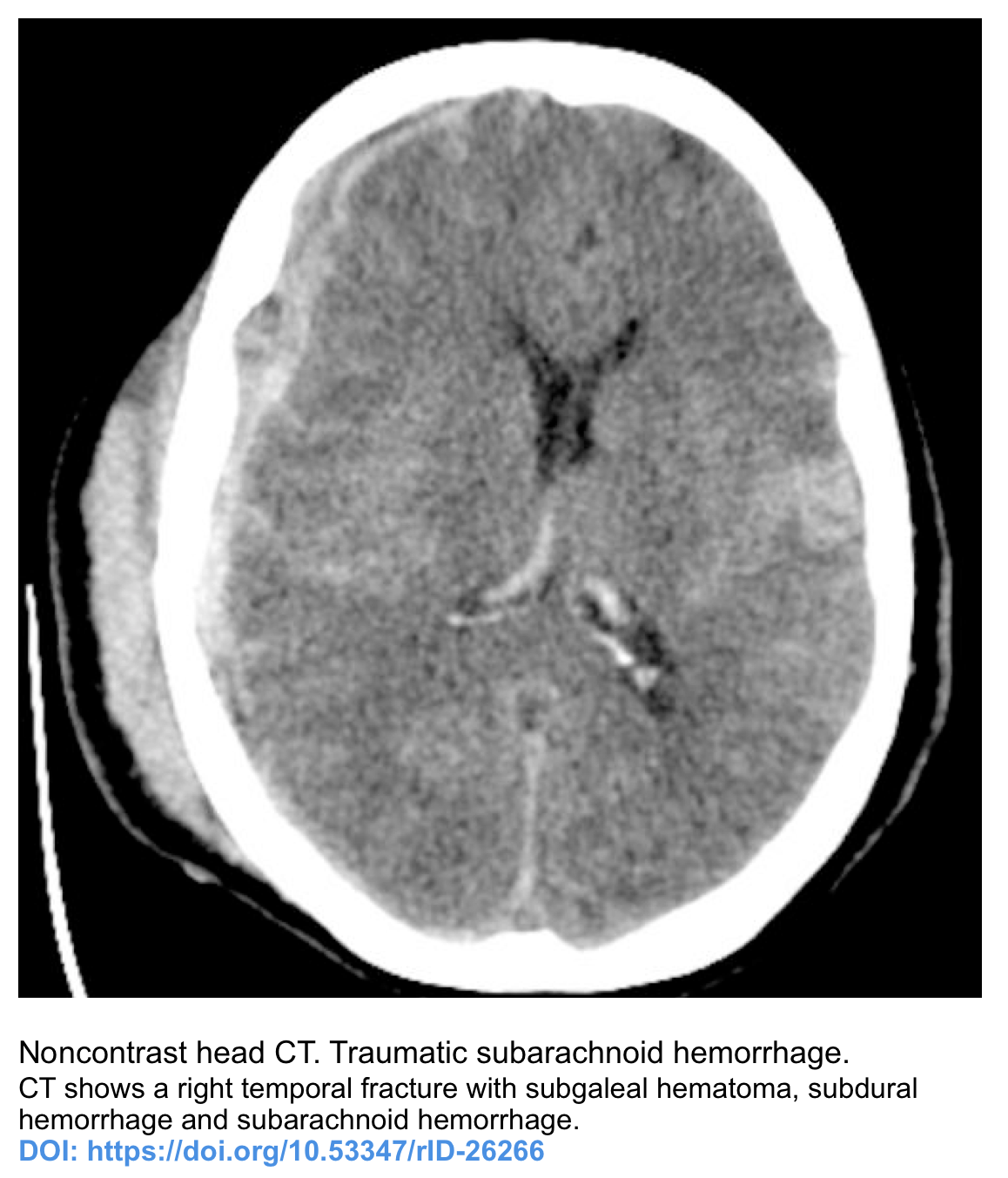 Subarachnoid Hemorrhage Subarachnoid Hemorrhage SAH Miniatlas Subarachnoid Hemorrhage Subarachnoid Hemorrhage SAH Miniatlas