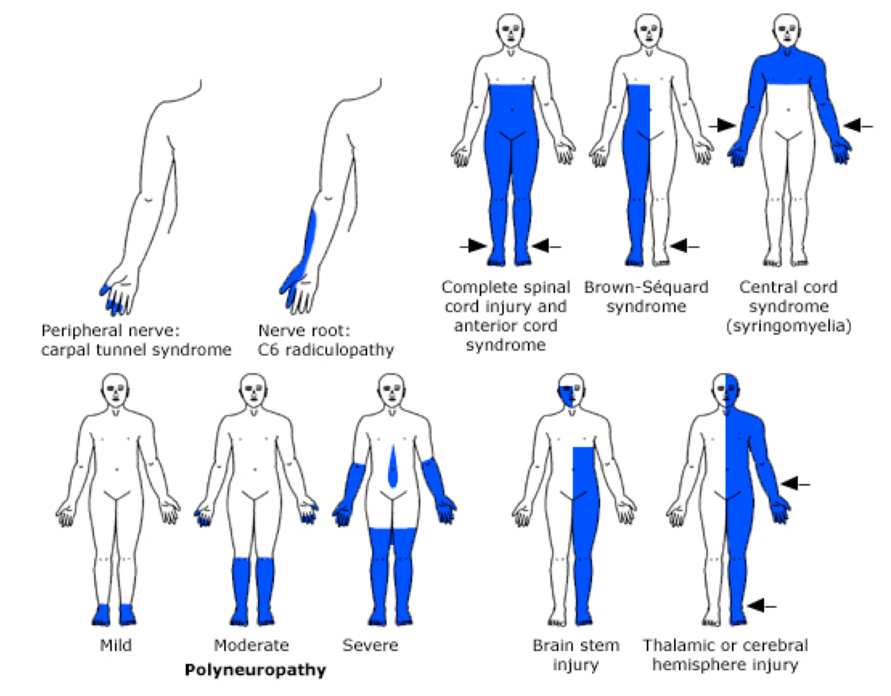 Causes Of Lower Motor Neuron Lesion Of Nerve Distributions Infoupdate