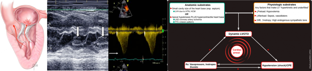 Dynamic Left Ventricular Outflow Tract Obstruction: Underestimated ...