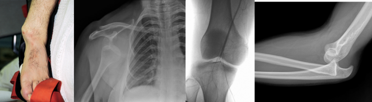 Major Joints Dislocations | RECAPEM