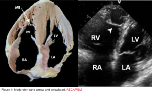 Acute Right Heart Failure: Principles of Diagnosis and Management In ...