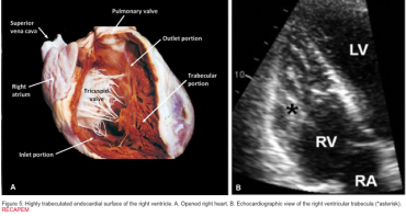 Acute Right Heart Failure: Principles of Diagnosis and Management In ...