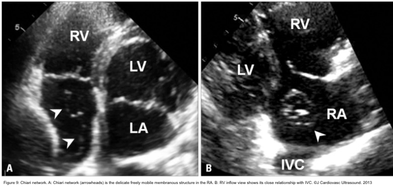 Acute Right Heart Failure: Principles of Diagnosis and Management In ...