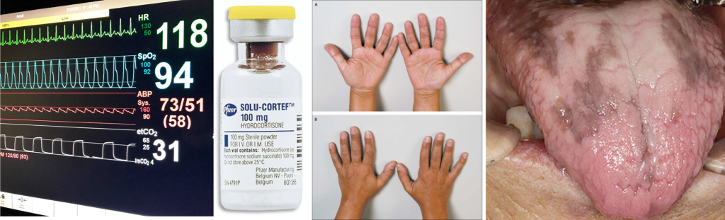 Adrenal Crisis: An Endocrinologic Cause of Shock State | RECAPEM