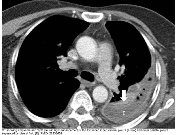 Pleural Effusion In Critically ill Patients | RECAPEM