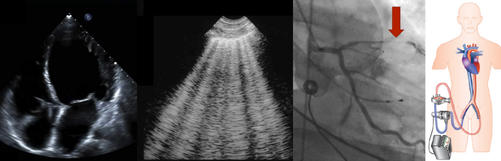 Cardiogenic Shock | RECAPEM
