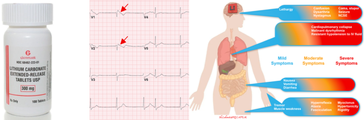 Lithium Toxicity | RECAPEM