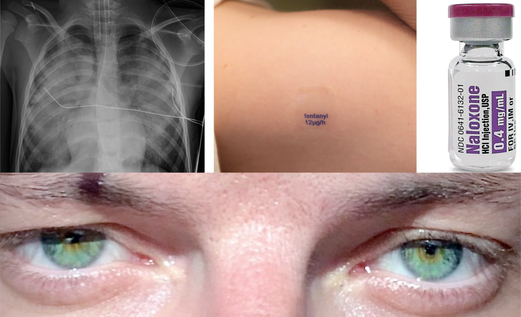 Opioid Intoxication Recapem